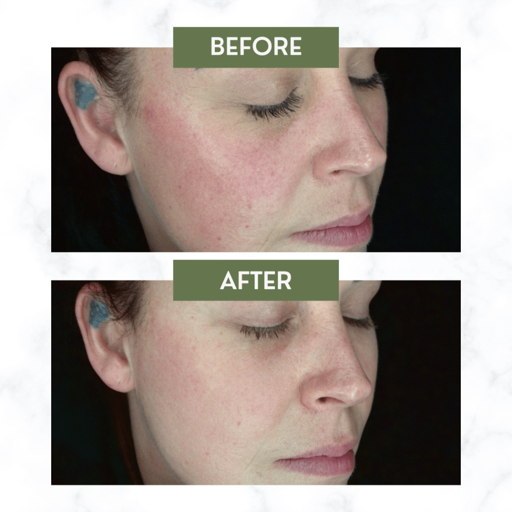 Couperose Behandeling | Laserbehandeling | Huidzorg Clinics