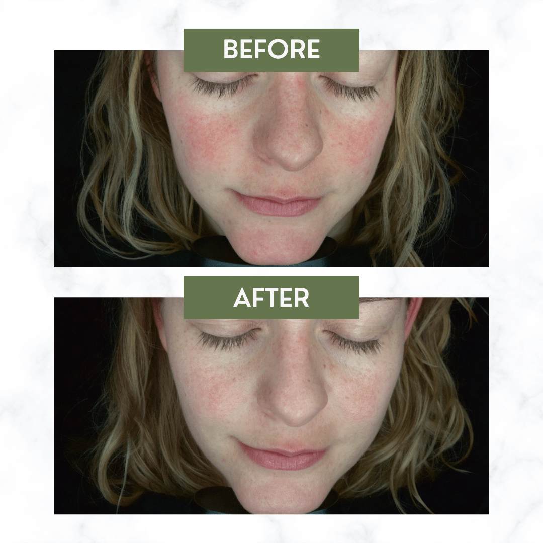Couperose Behandeling | Laserbehandeling | Huidzorg Clinics