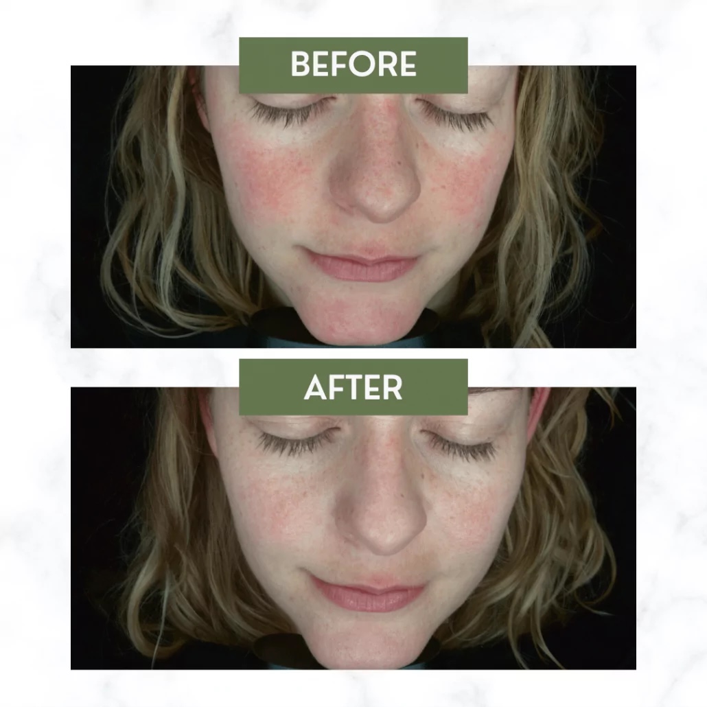 Couperose Behandeling | Laserbehandeling | Huidzorg Clinics